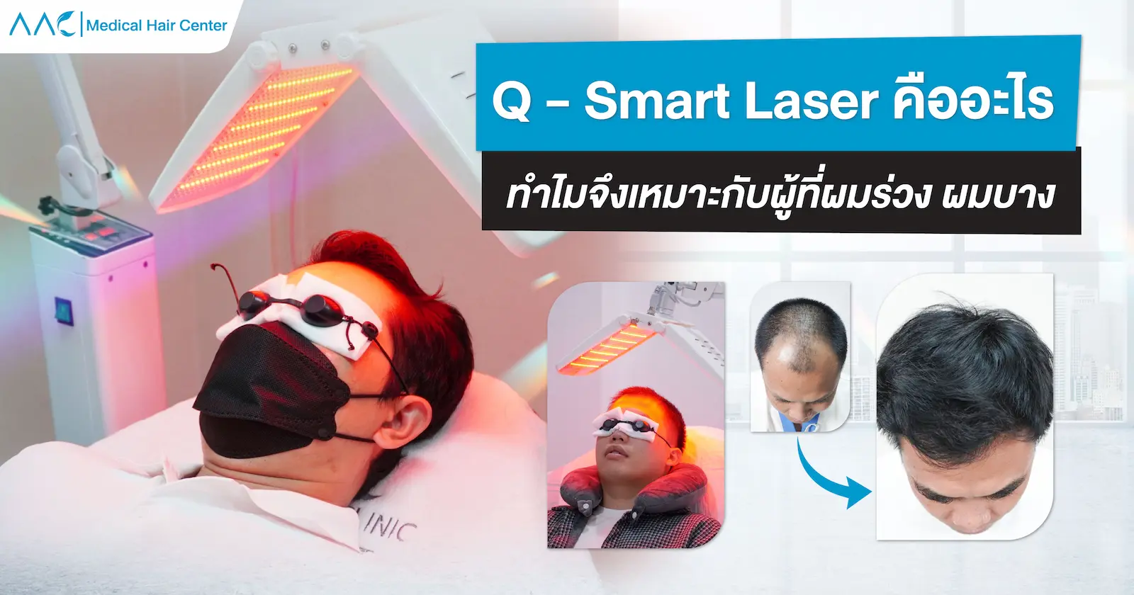Q Smart Laser คืออะไร ทำไมจึงเหมาะกับผู้ที่ผมร่วง ผมบาง - AAC HAIR ...